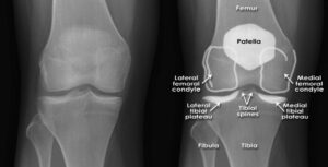 KNEE FRACTURES - Midwest Orthopaedics