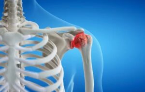 TOTAL SHOULDER ARTHROPLASTY - Midwest Orthopaedics